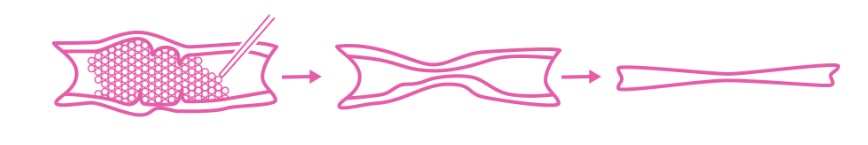 Varicose Vein Treatments & Removal in Denver | DVC